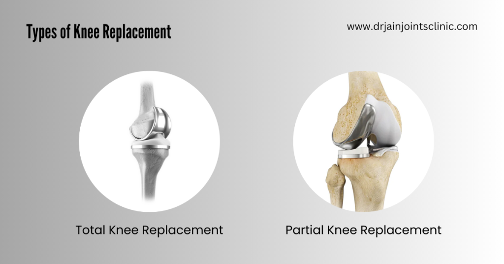Knee Replacement Surgery in Jaipur | Dr. Rohan Jain